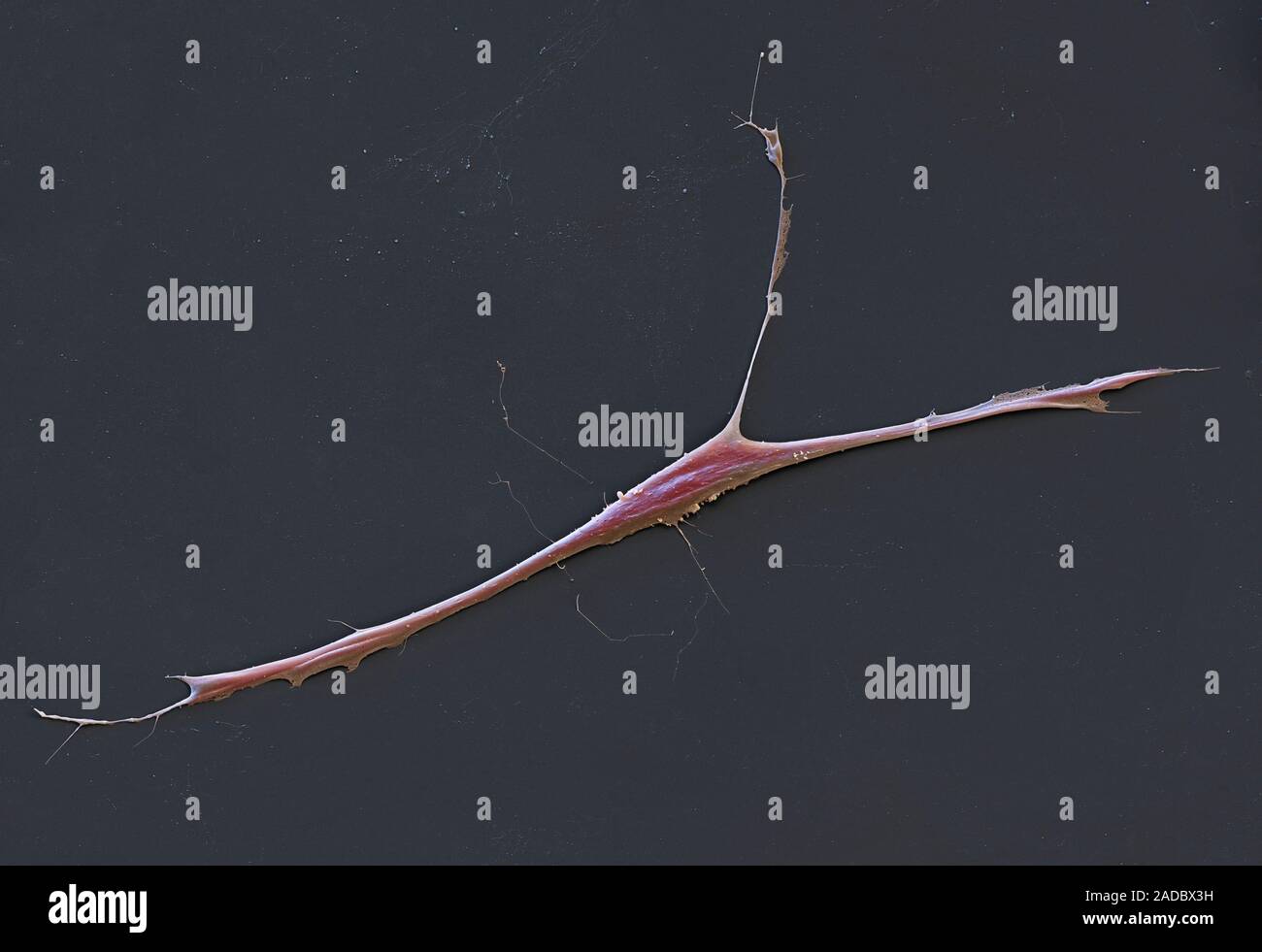 Rhabdomyosarcoma cancer cell, coloured scanning electron micrograph ...