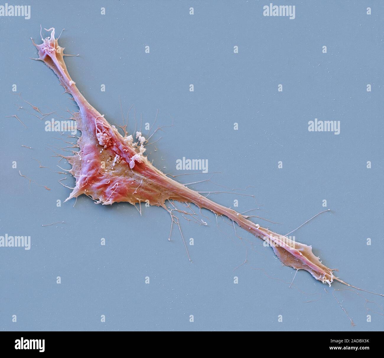 Rhabdomyosarcoma cancer cell, coloured scanning electron micrograph ...