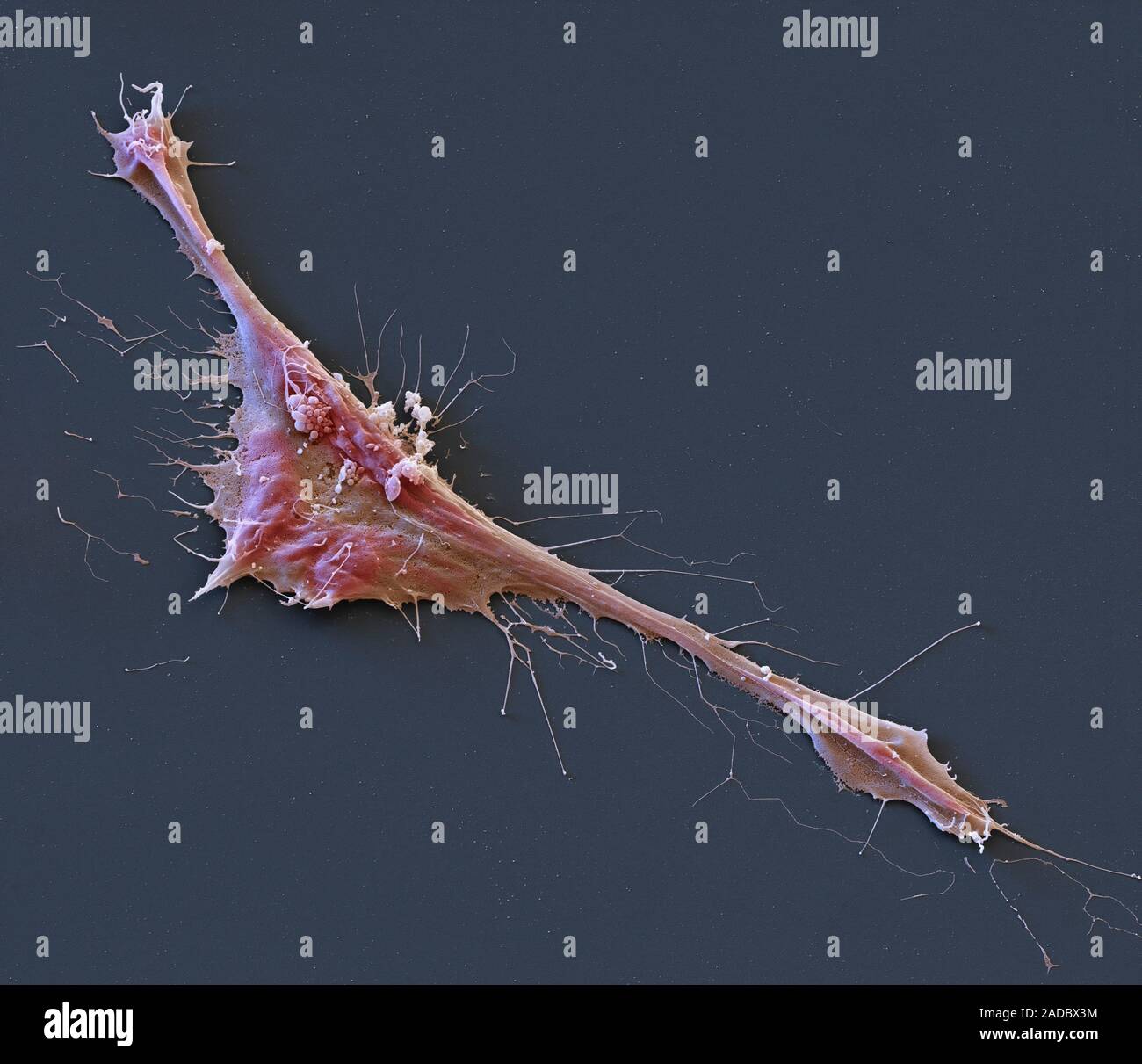 Rhabdomyosarcoma cancer cell, coloured scanning electron micrograph ...