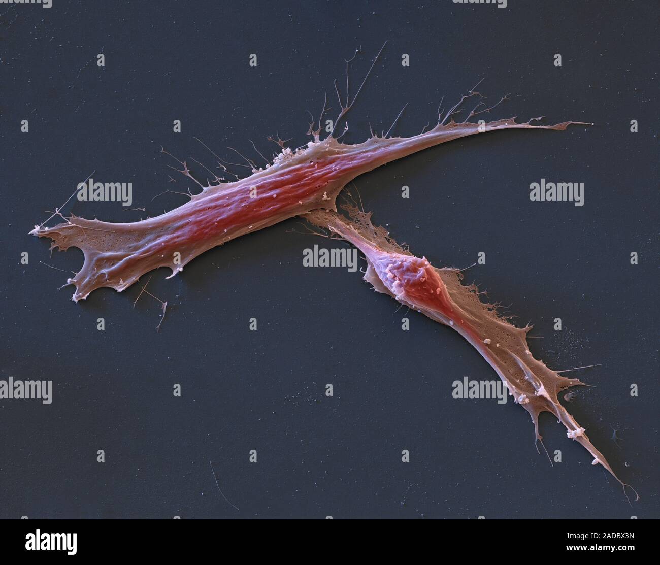 Rhabdomyosarcoma cancer cells, coloured scanning electron micrograph ...
