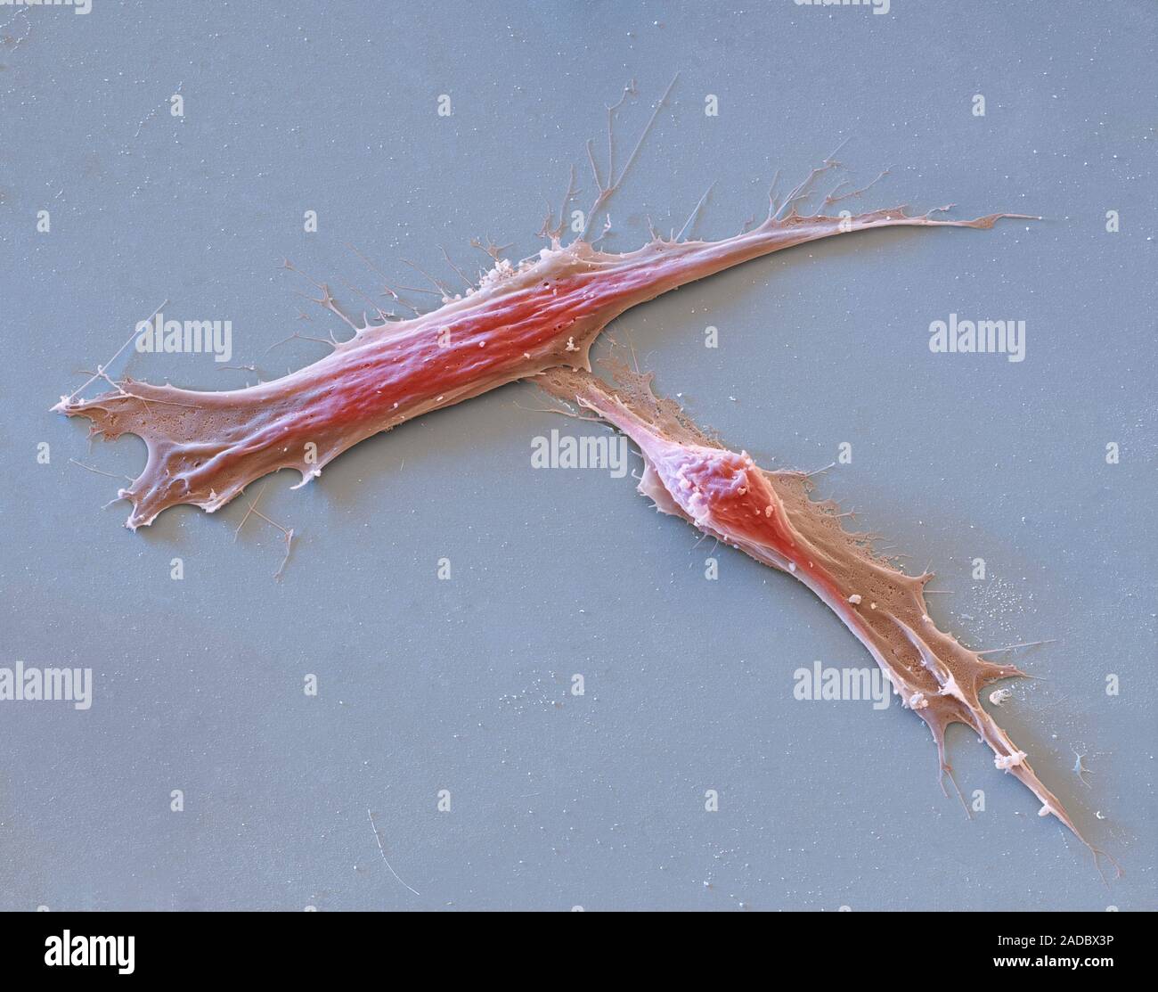 Rhabdomyosarcoma cancer cells, coloured scanning electron micrograph ...