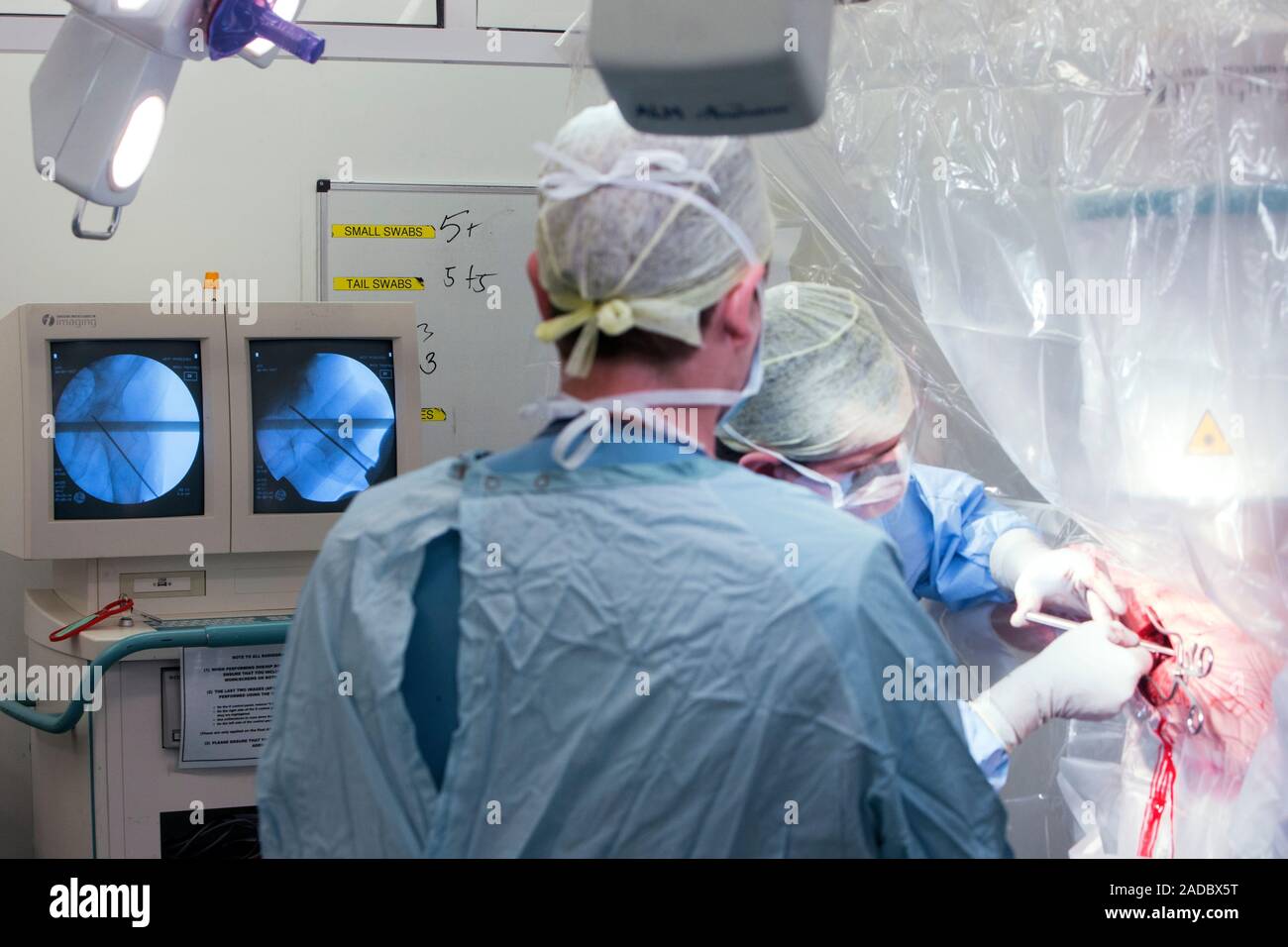 Hip replacement surgery. Surgeons performing hip replacement surgery ...