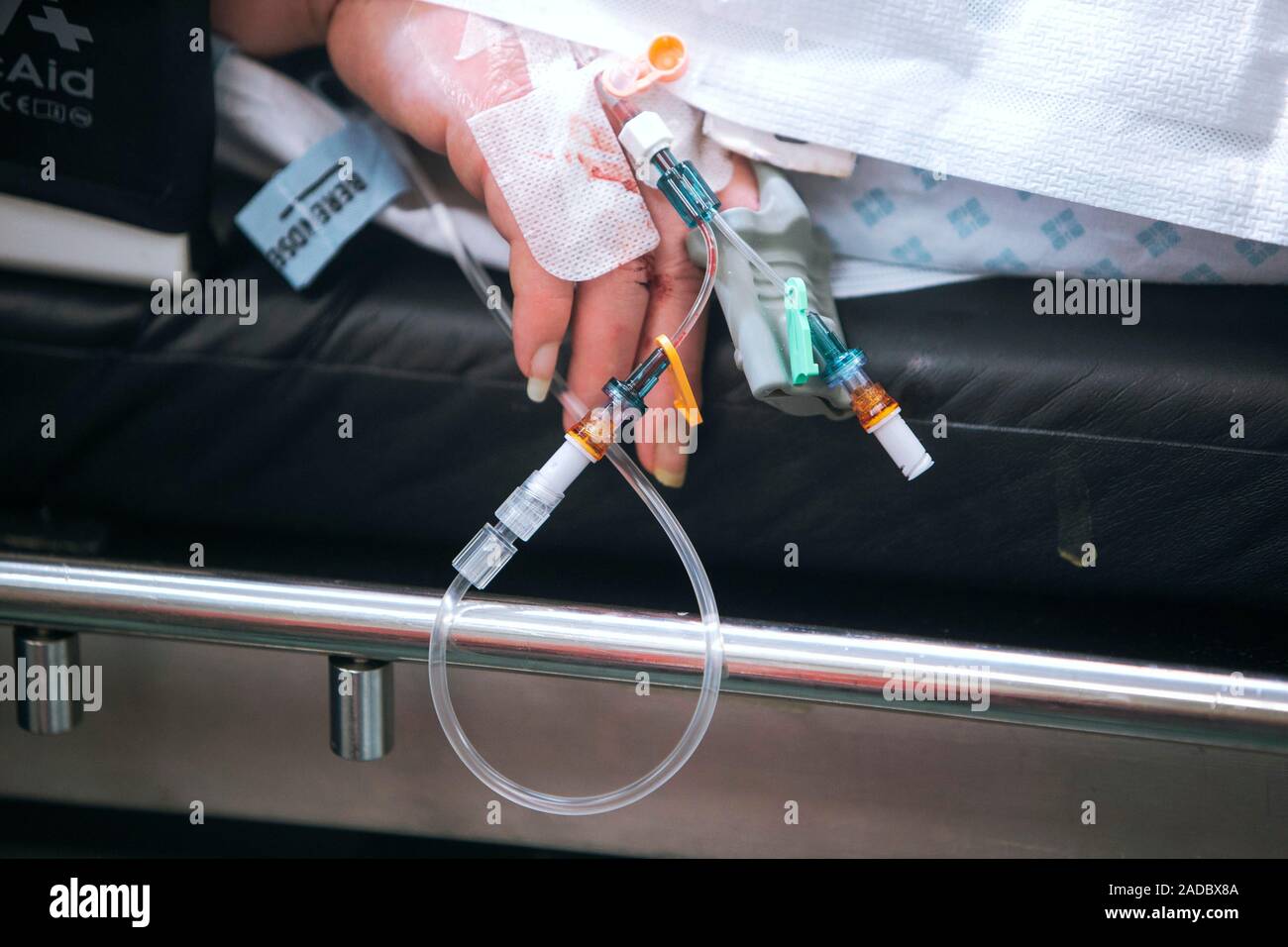 Canulated patient. Close-up of a cannula in the back of a female ...