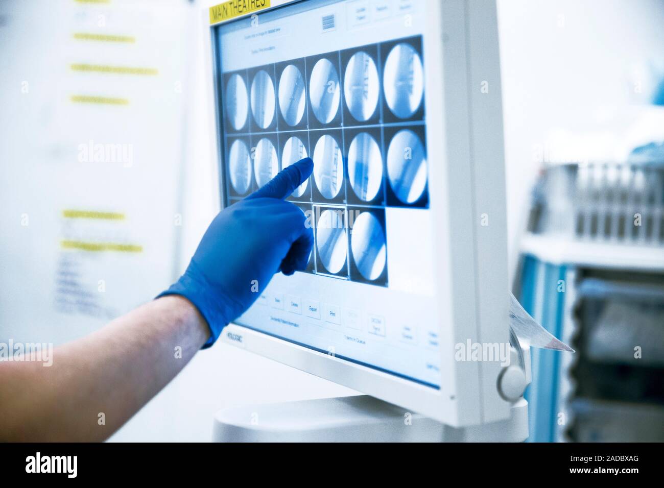 Surgeon checking X-rays. Surgeon reviewing a patient's X-rays onscreen ...