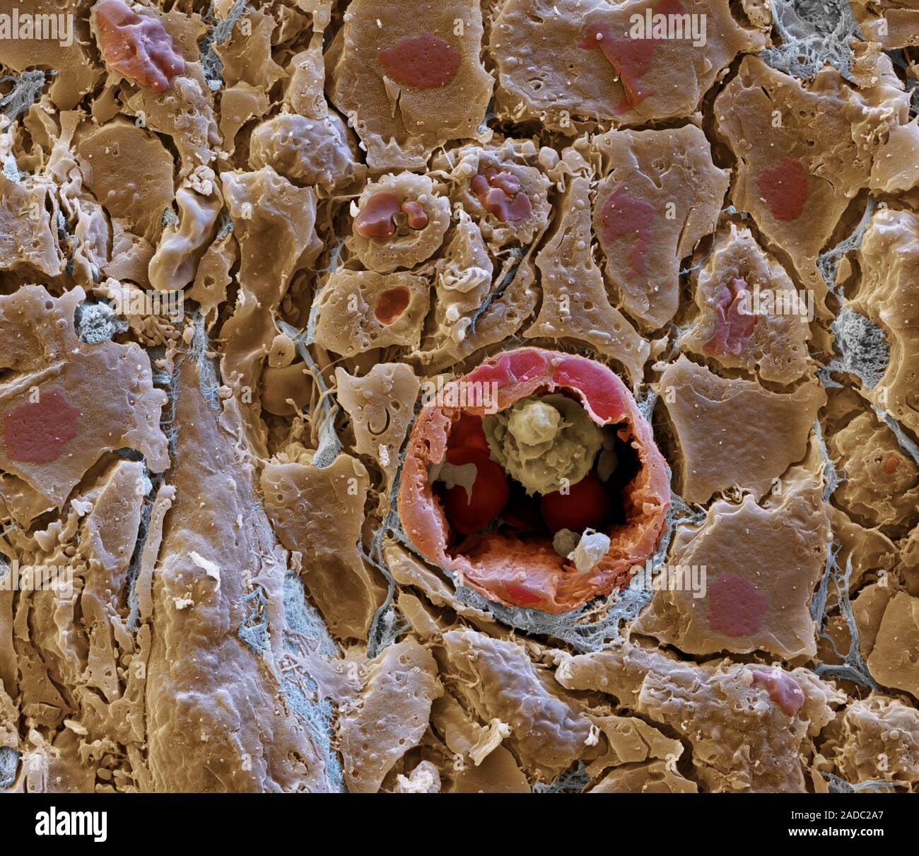 Blood vessel in cancerous tissue. Coloured scanning electron micrograph ...