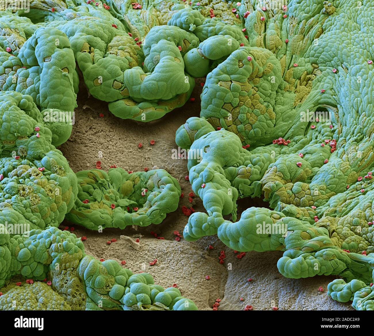 Damaged gallbladder tissue. Coloured scanning electron micrograph (SEM ...