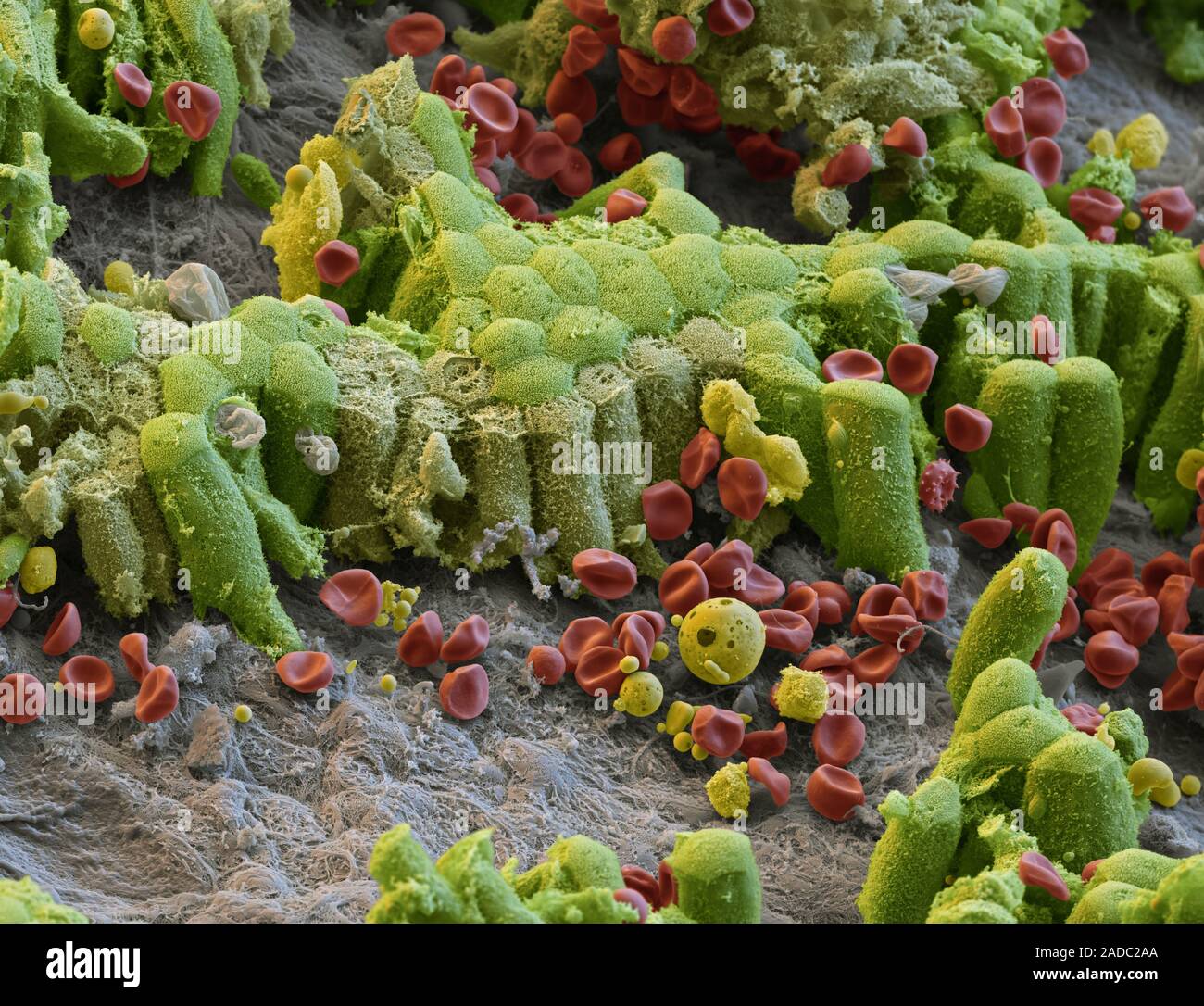 Damaged gallbladder tissue. Coloured scanning electron micrograph (SEM ...