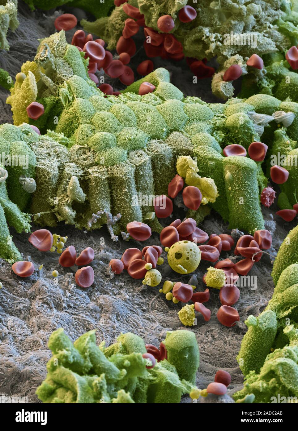 Damaged gallbladder tissue. Coloured scanning electron micrograph (SEM ...