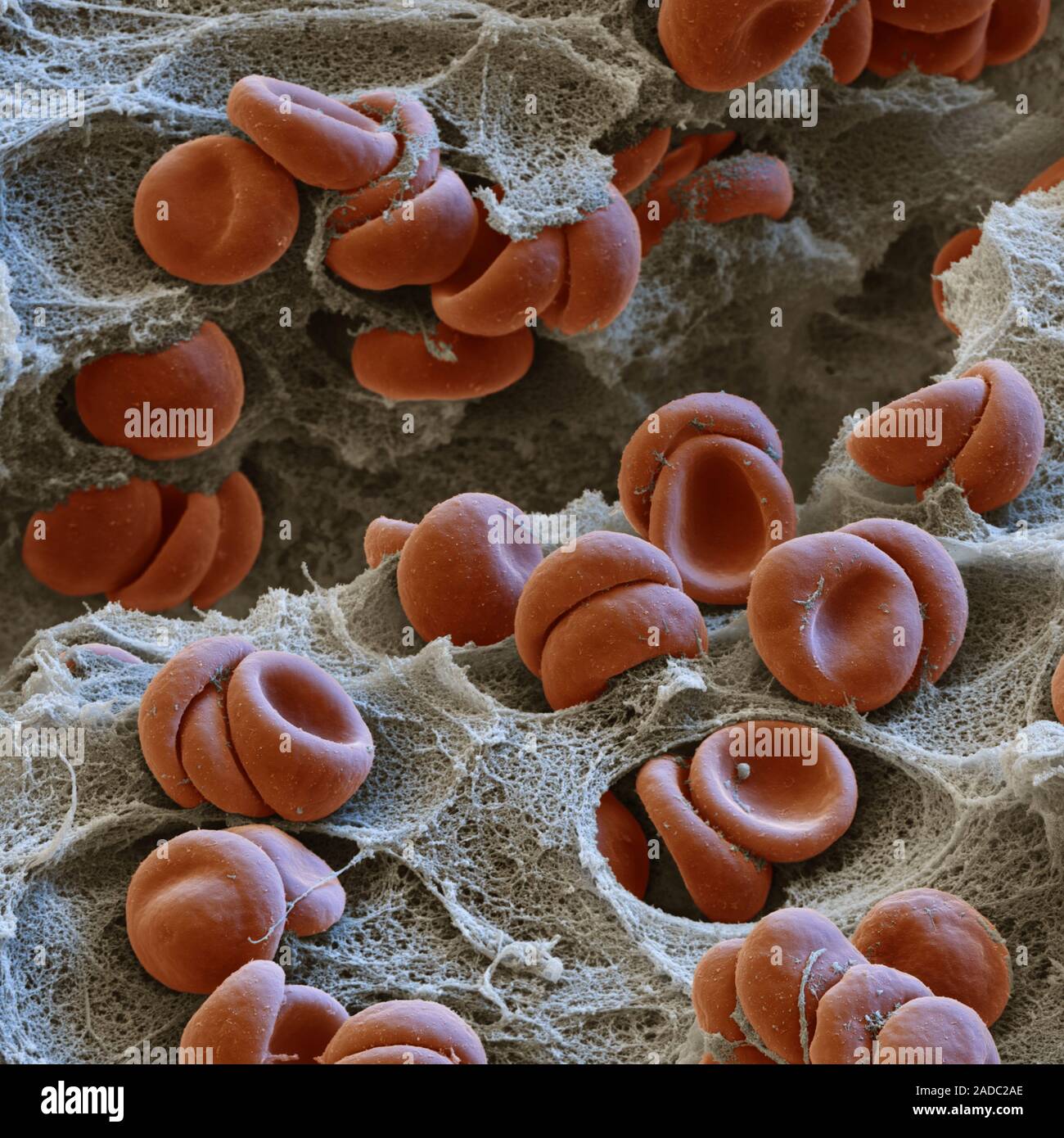 Blood clot. Coloured scanning electron micrograph (SEM) of red blood ...