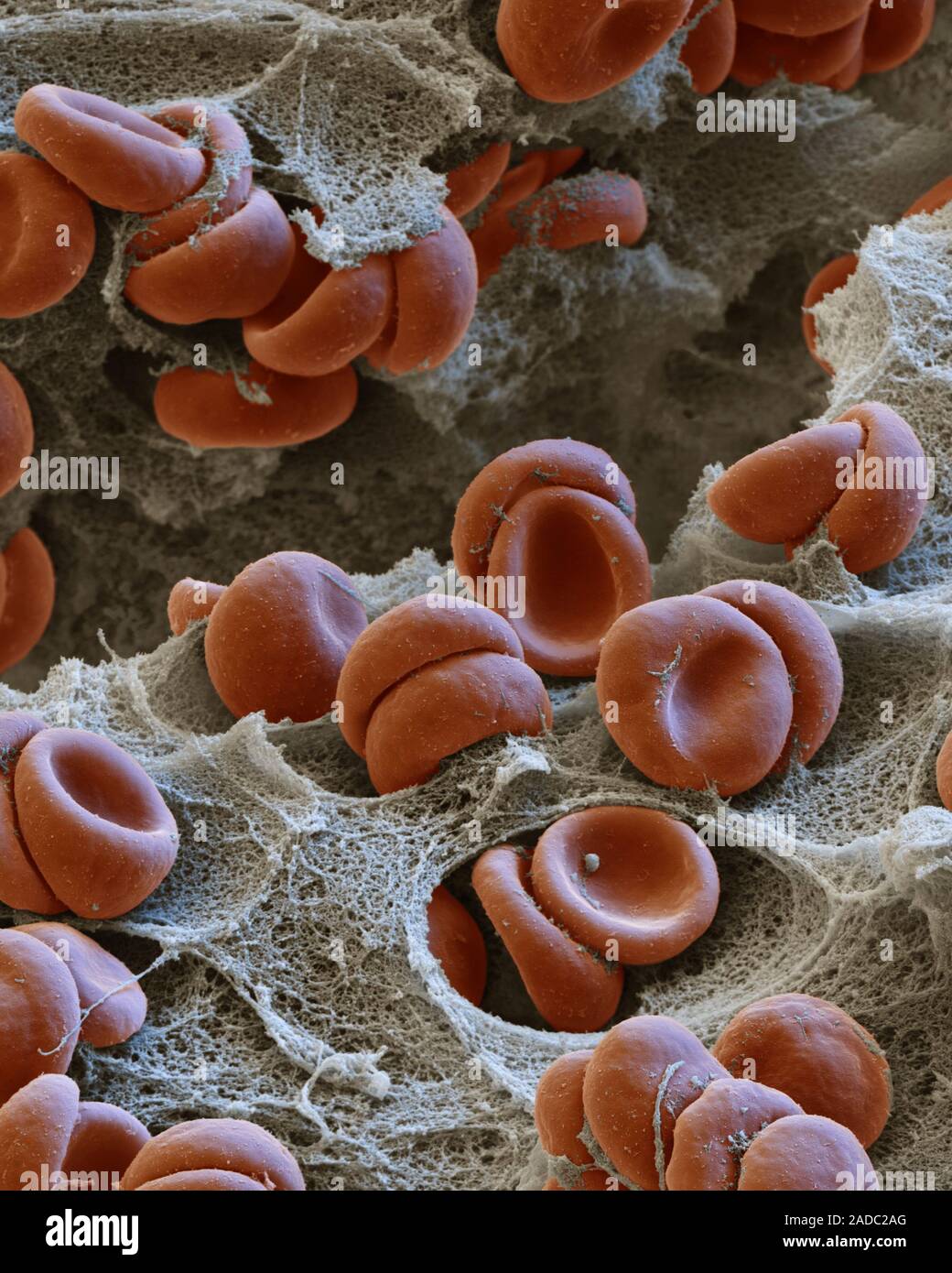 Blood clot. Coloured scanning electron micrograph (SEM) of red blood ...
