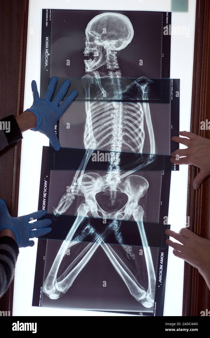 Peruvian mummy, X-ray research. Researchers examining combined whole ...
