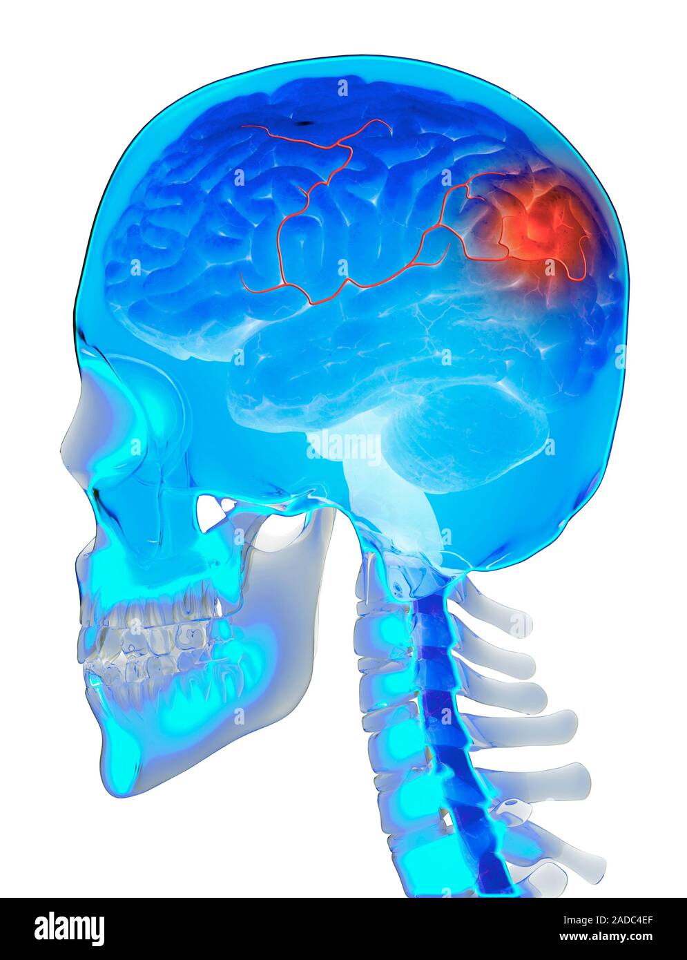 Brain haemorrhage. Illustration of a sectioned human head and brain ...
