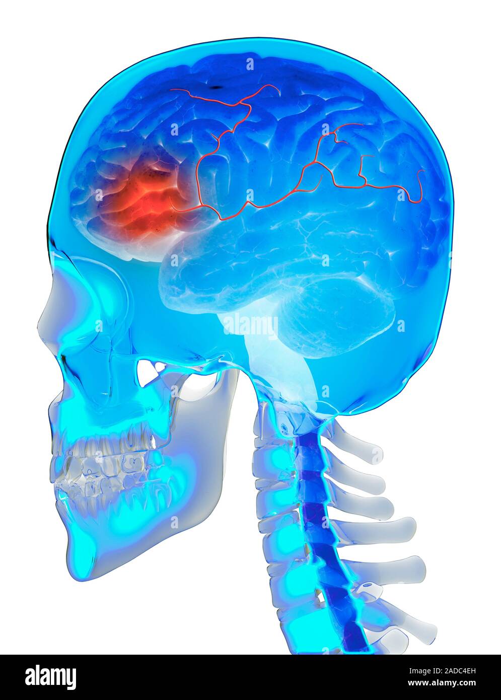 Brain haemorrhage. Illustration of a sectioned human head and brain ...