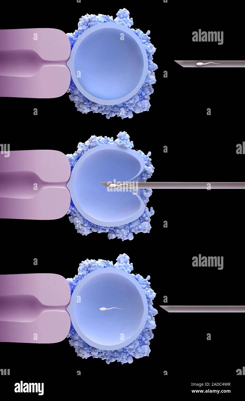 ICSI in vitro fertilisation. Computer illustrations showing a human egg ...