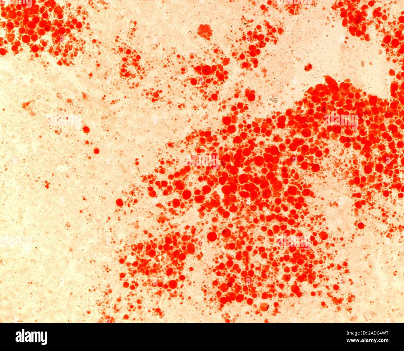 Light micrograph of a fatty liver (steatosis) stained with oil red O to ...