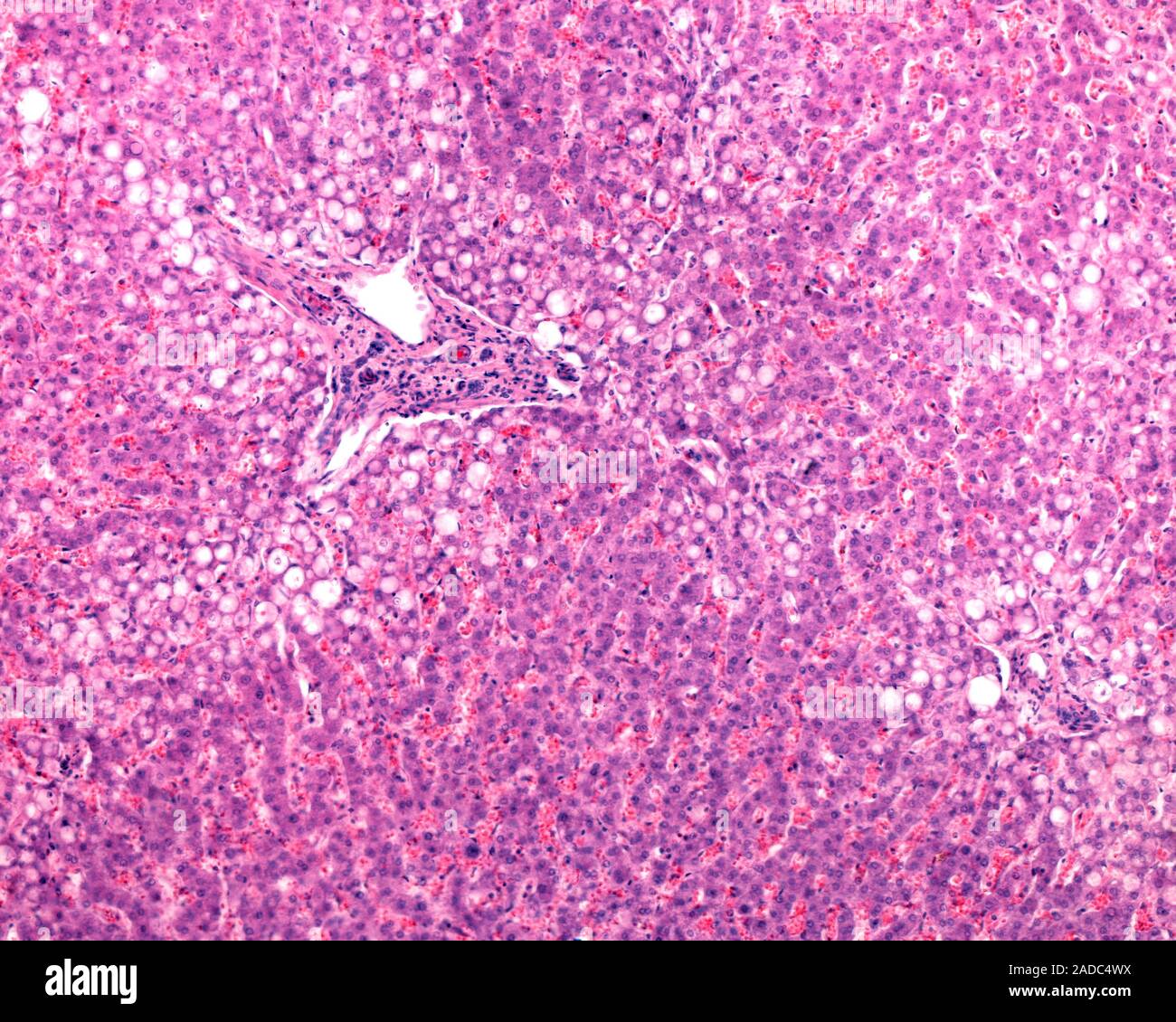 Light micrograph of fatty liver disease. This is periportal (zone 1 ...