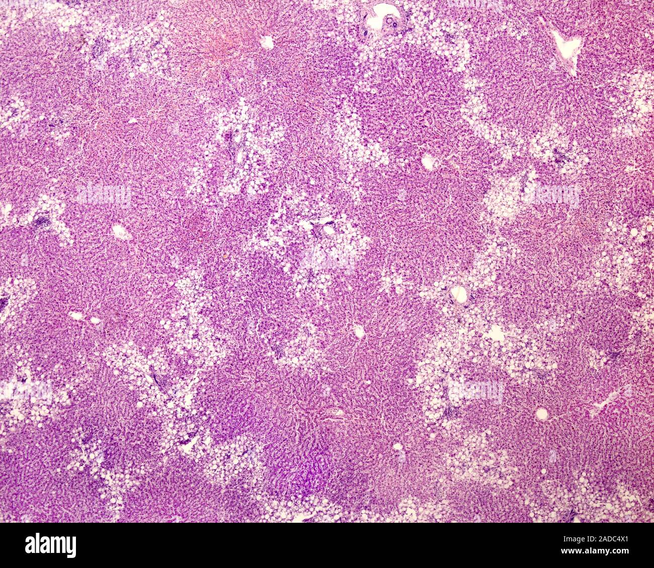 Light micrograph of fatty liver disease. This is periportal (zone 1 ...