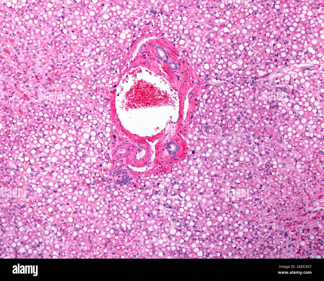 Light micrograph of the parenchyma of a liver affected by diffuse and ...