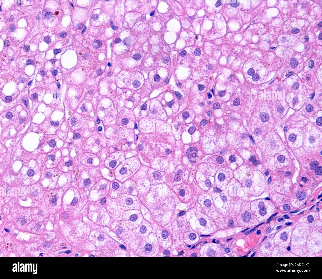 Light micrograph of a liver with macrovesicular steatosis (fatty liver ...