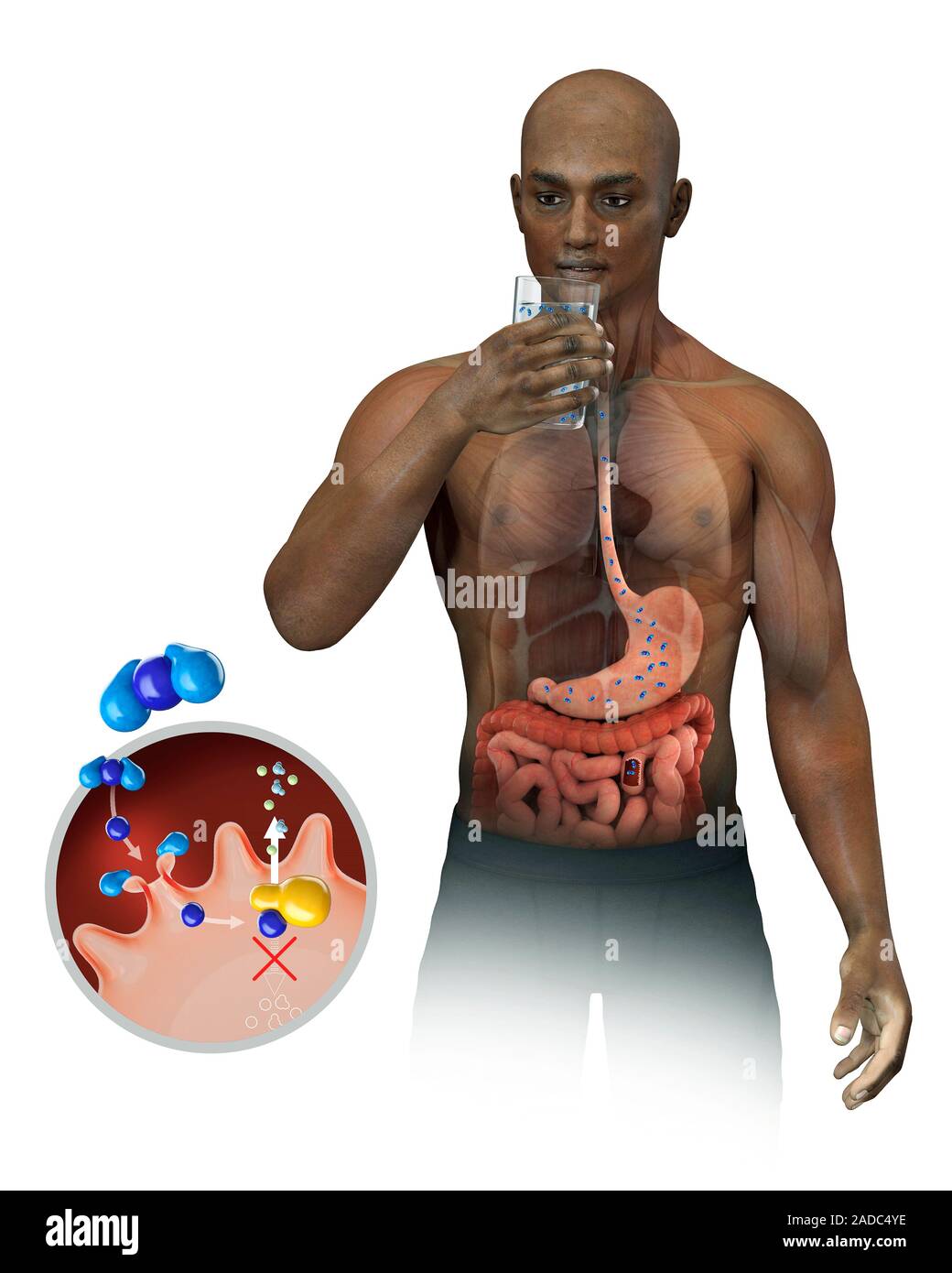Cholera intestinal infection, illustration. Cholera is a bacterial ...