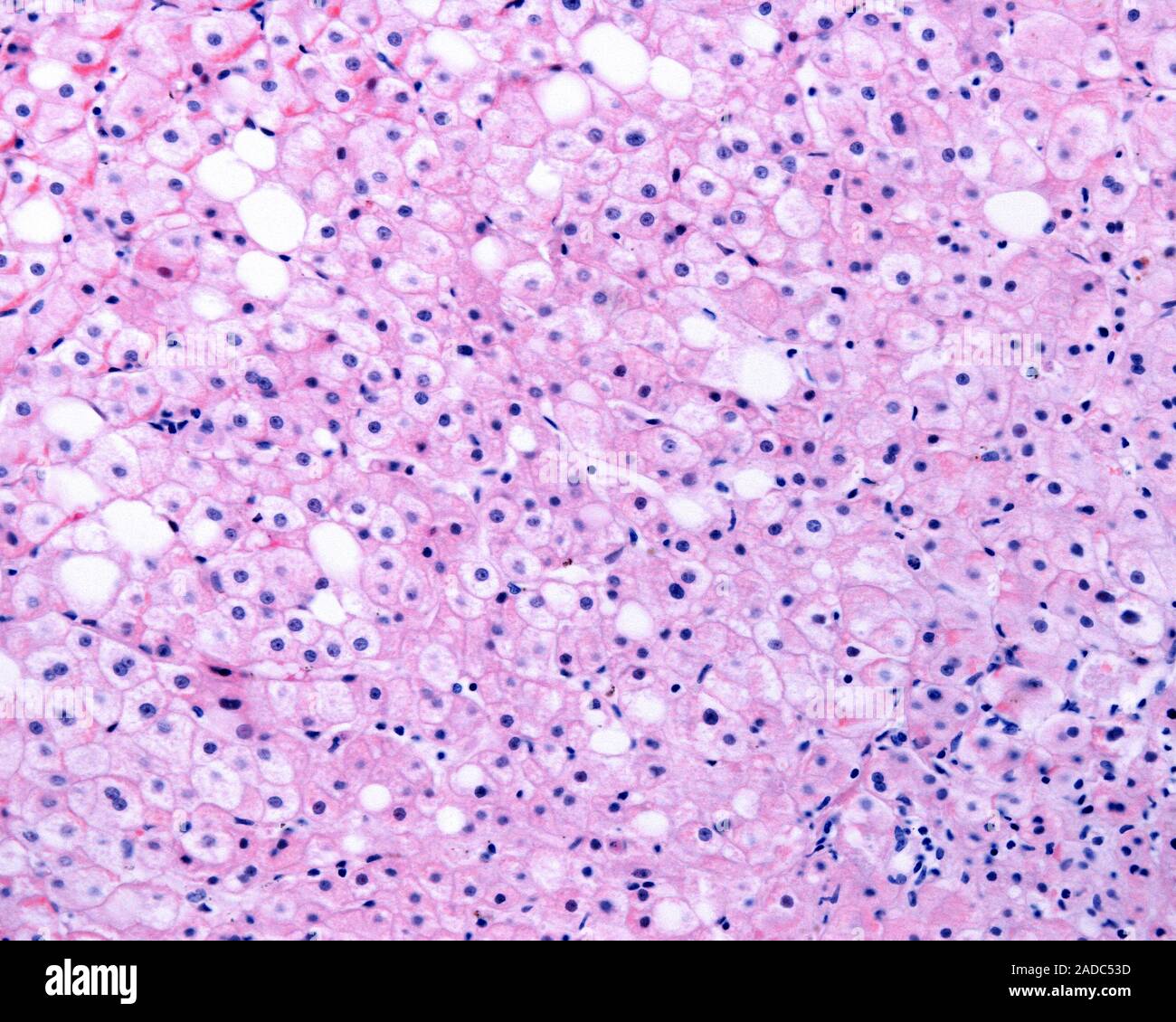 Light micrograph of a liver with macrovesicular steatosis (fatty liver ...