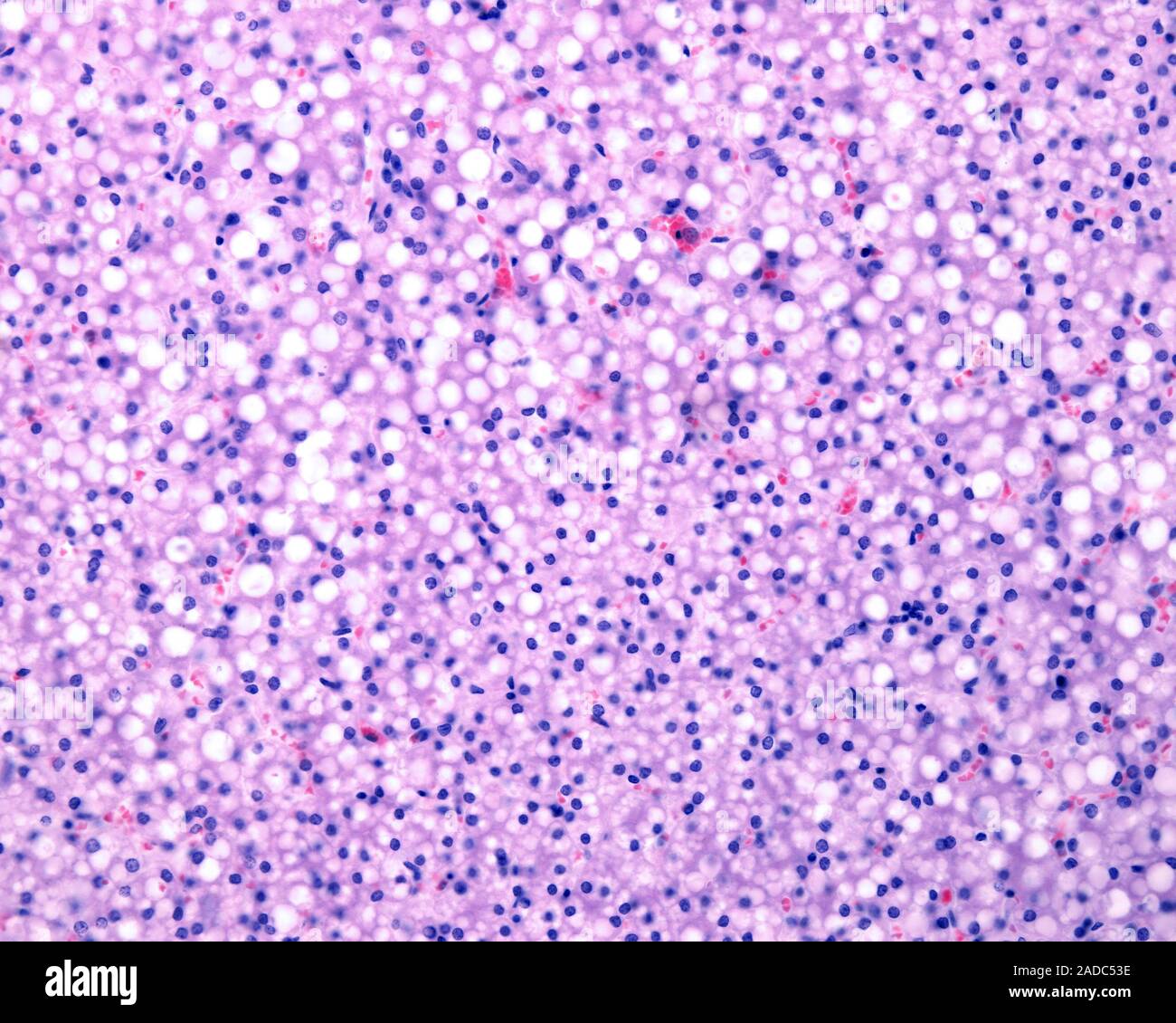 Light micrograph of a liver with macrovesicular steatosis (fatty liver ...