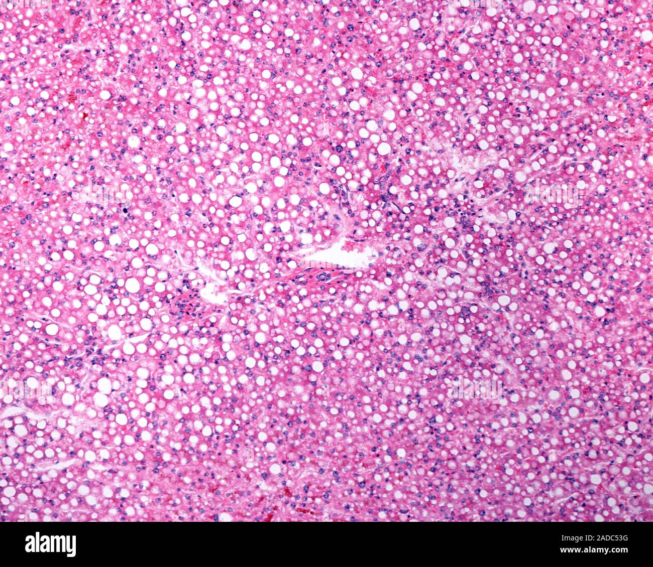 Light micrograph of the parenchyma of a liver affected by diffuse and ...