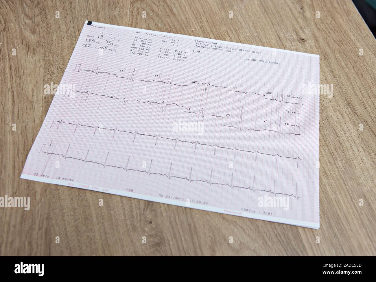 Electrocardiography test results. Printed results of an ...