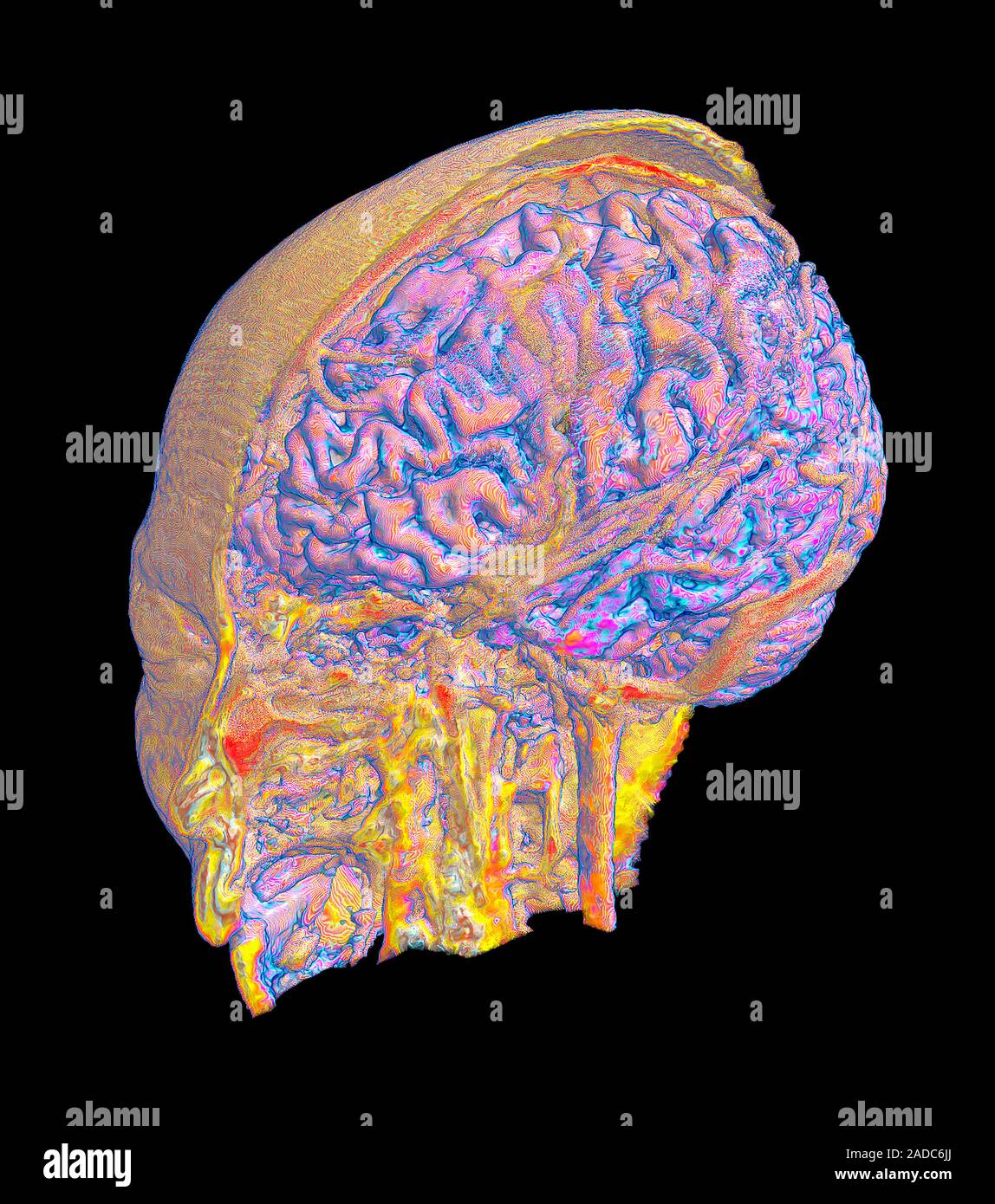 Human brain. Digitally enhanced 3D magnetic resonance imaging (MRI) scan of a normal brain, with ...