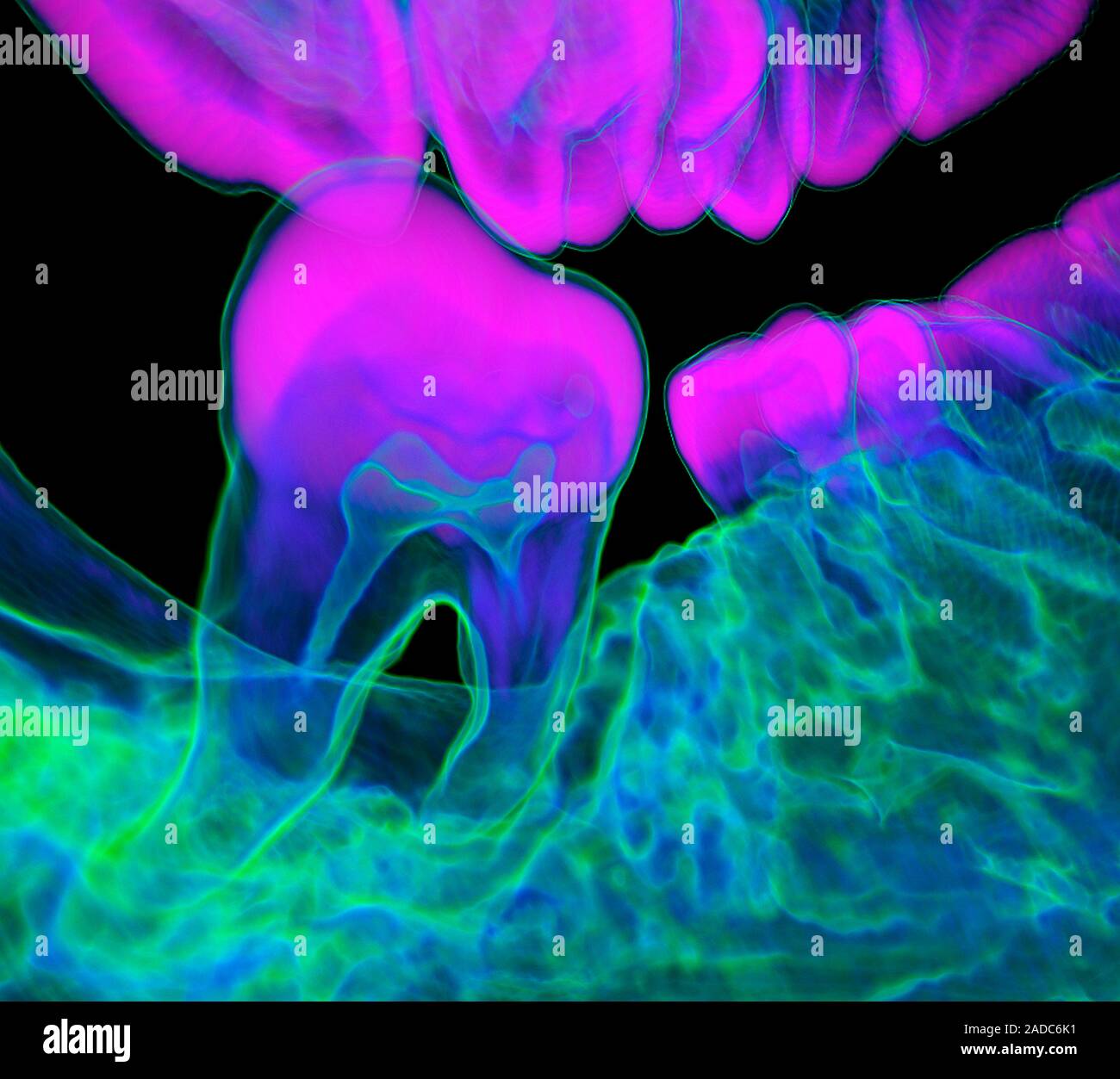 Human teeth. Digitally enhanced 3D computed tomography (CT) scan of ...