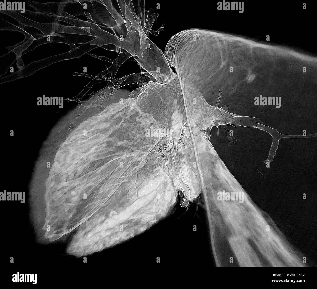 Human heart. Digitally enhanced 3D computed tomography (CT) scan of a ...