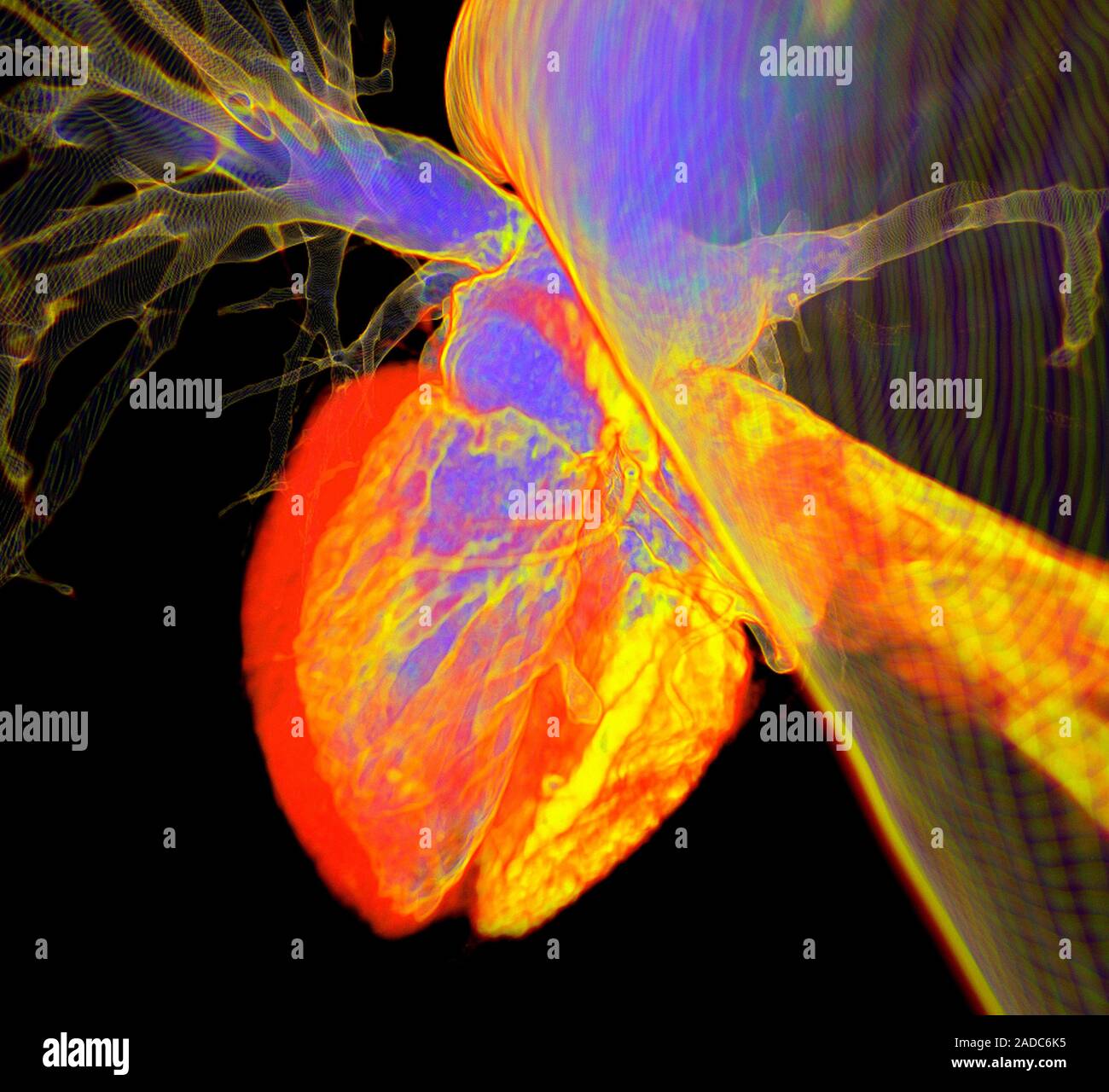 Human heart. Digitally enhanced 3D computed tomography (CT) scan of a ...