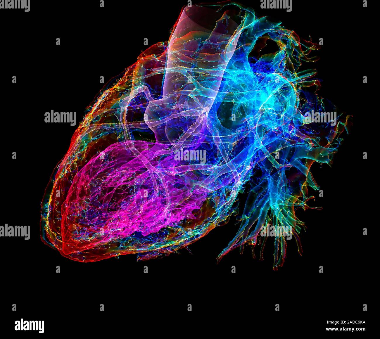 Human heart. Digitally enhanced 3D computed tomography (CT) scan of a ...