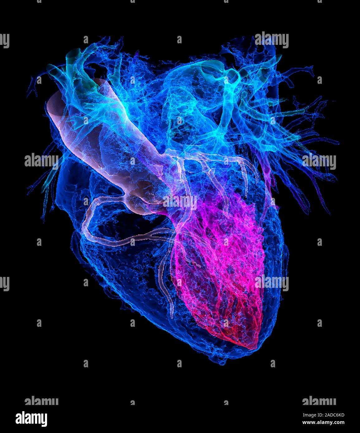 Human heart. Digitally enhanced 3D computed tomography (CT) scan of a ...