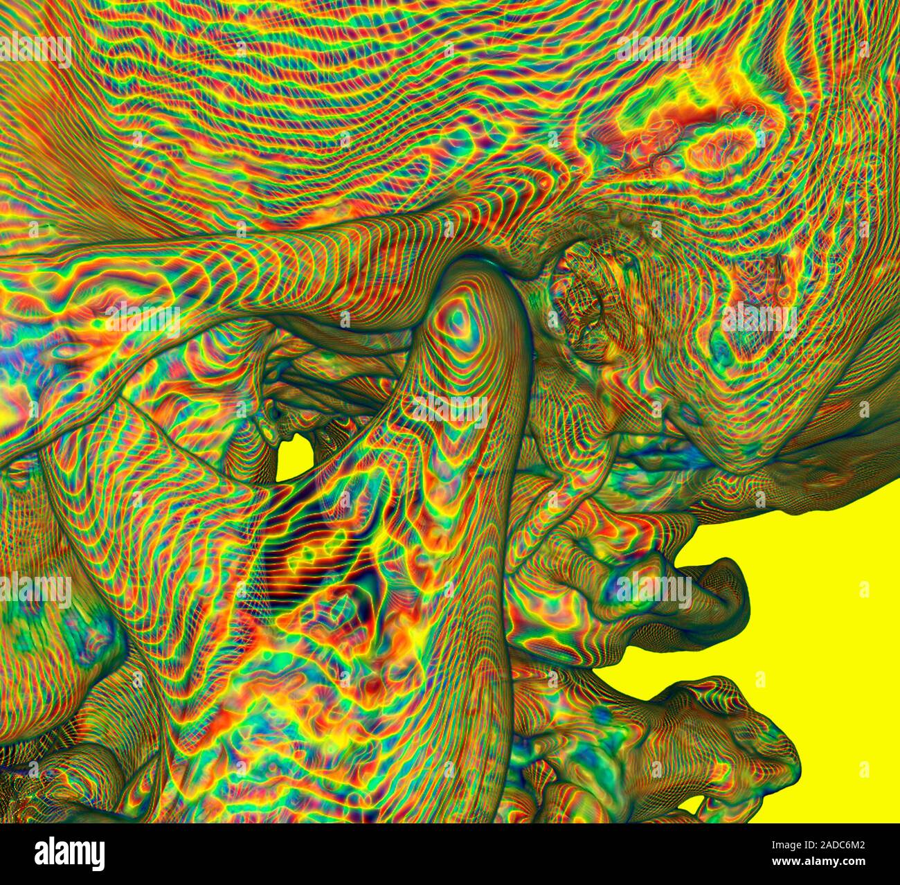 Temporomandibular joint. Digitally enhanced 3D computed tomography (CT ...