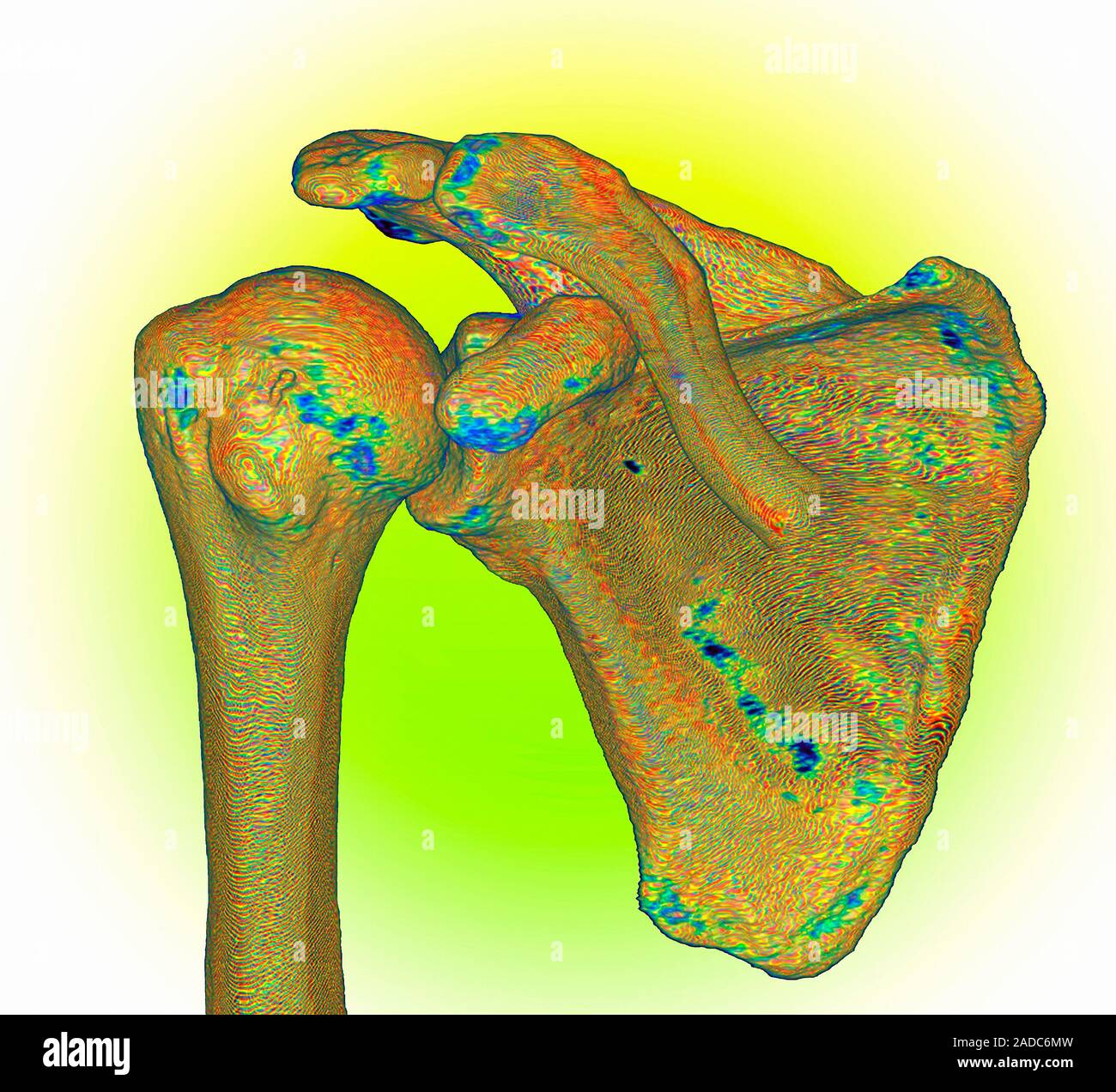Shoulder bones. Digitally enhanced 3D computed tomography (CT) scan of ...