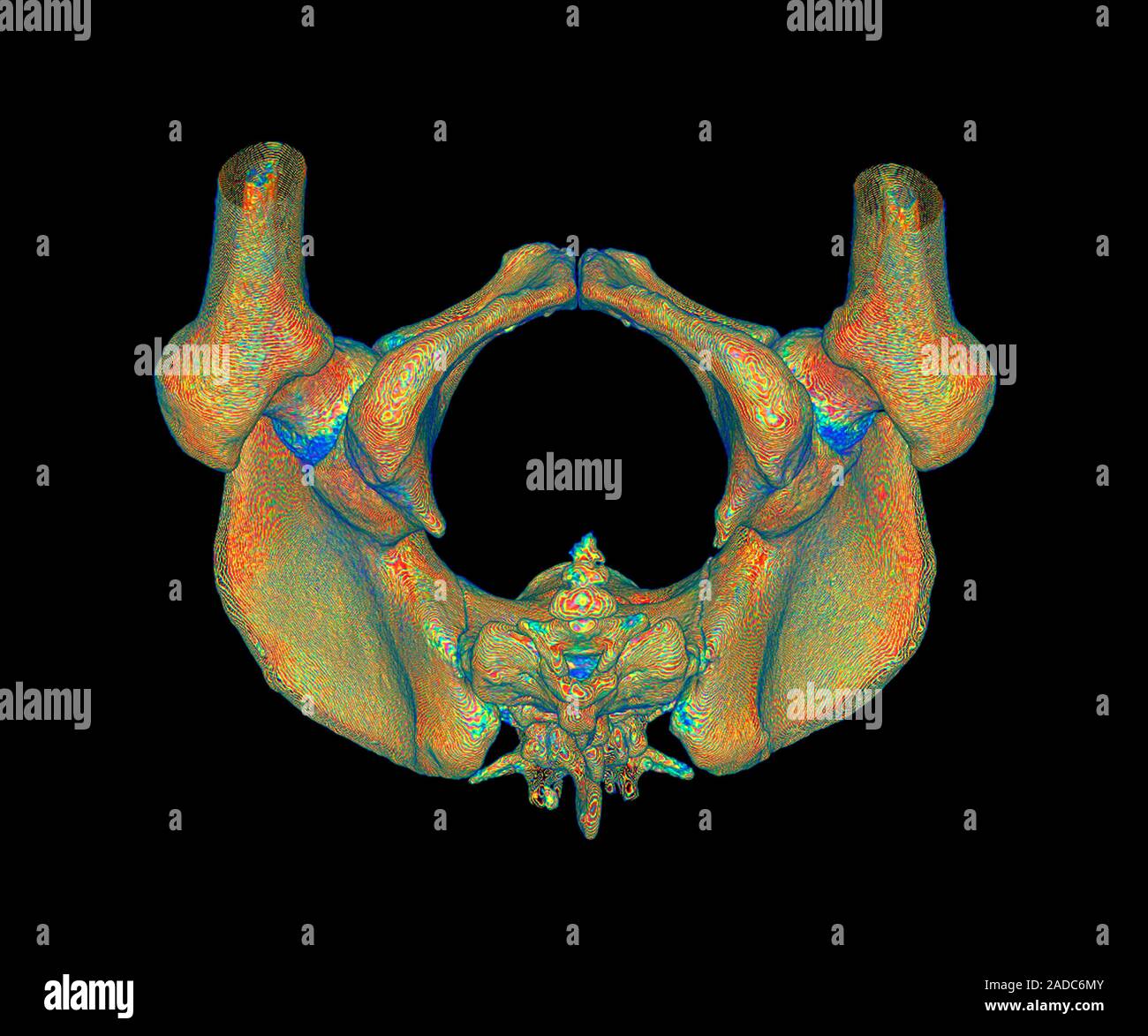 Female pelvis. Digitally enhanced 3D computed tomography (CT) scan of ...