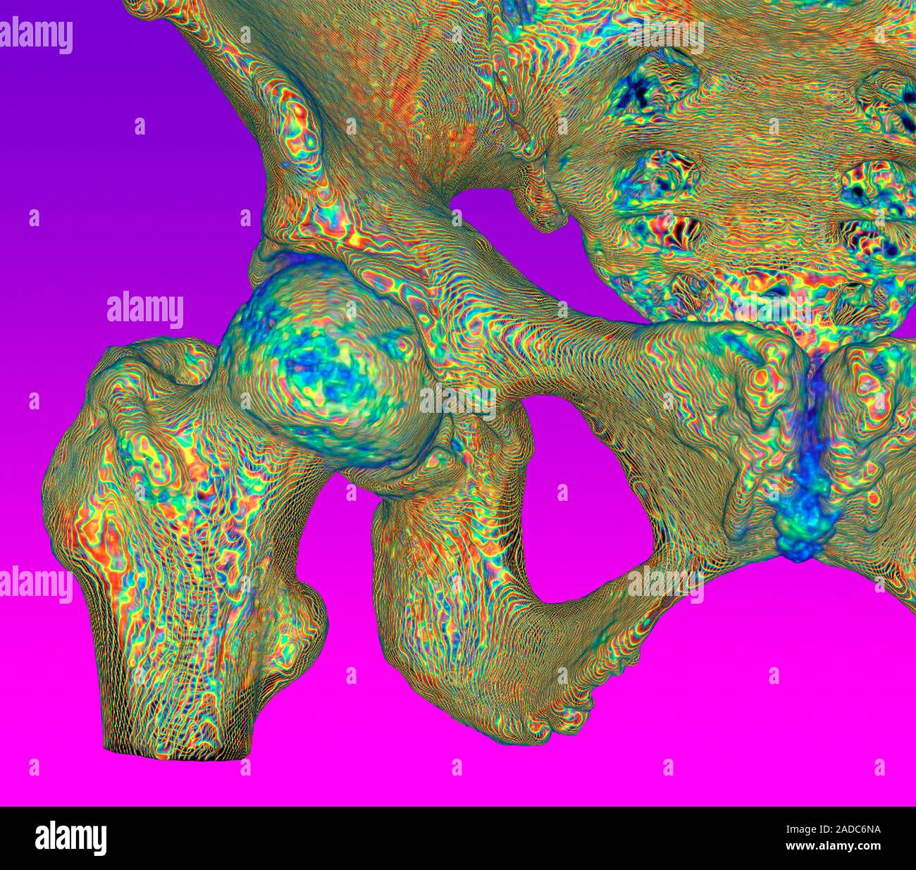 Human hip bones. Digitally enhanced 3D computed tomography (CT) scan of ...
