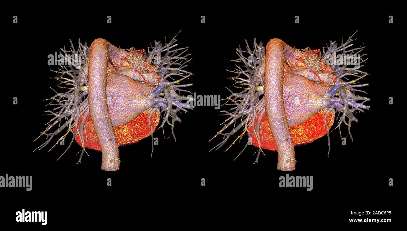 Heart and pulmonary blood vessels. Digitally enhanced 3D computed ...