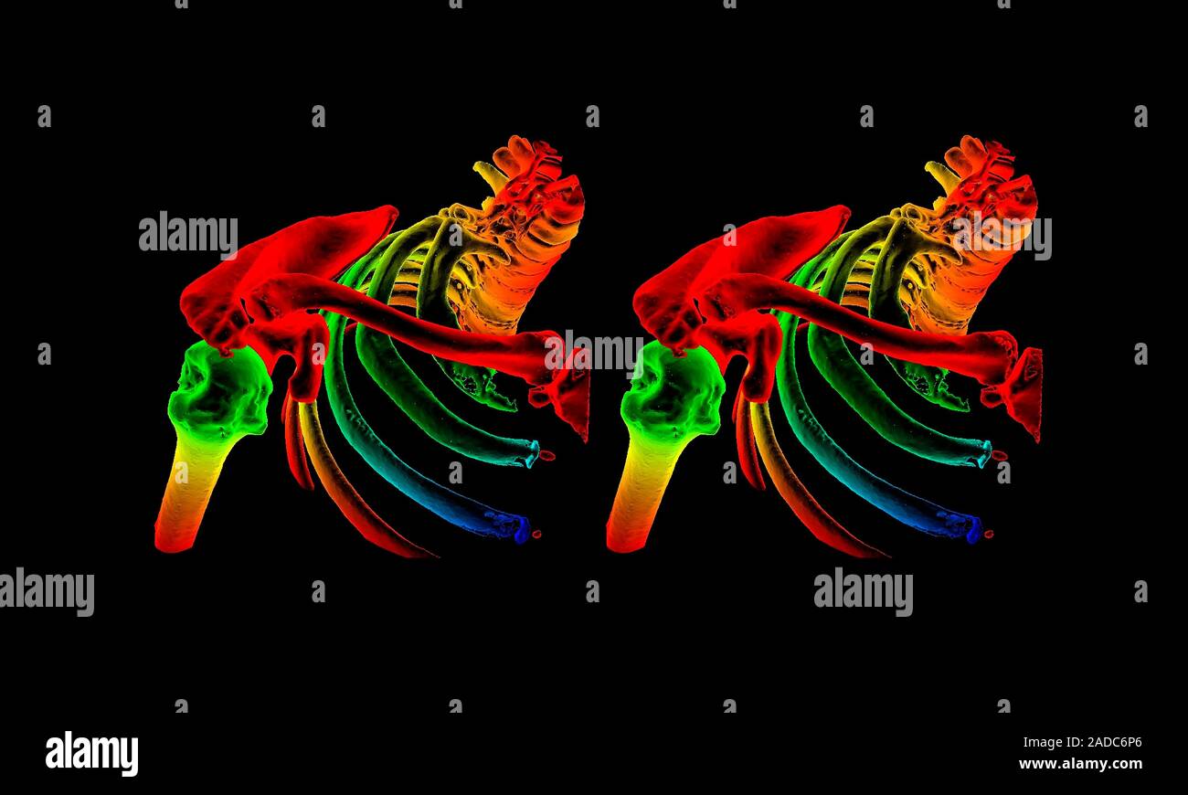 Shoulder bones. Digitally enhanced 3D computed tomography (CT) scan ...