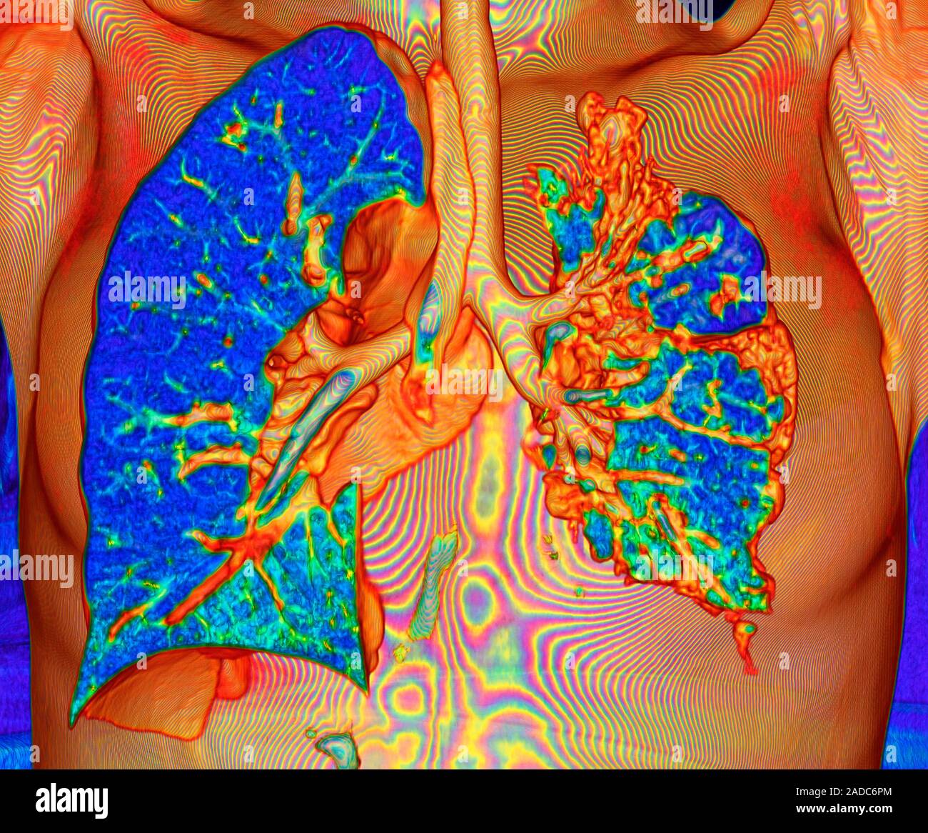 Collapsed lung. Digitally enhanced 3D computed tomography (CT) scan of ...
