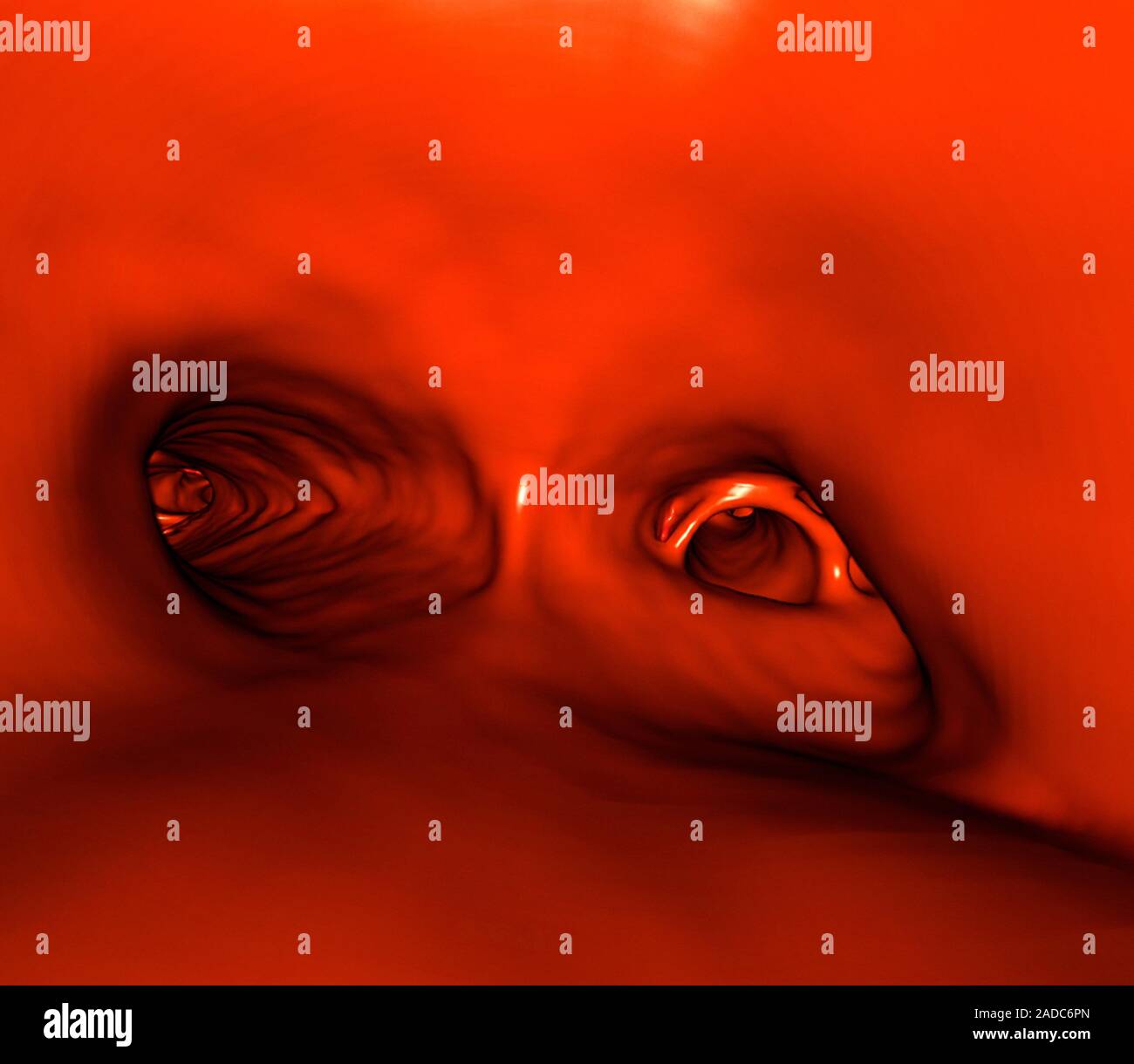 Bronchoscopy view. Digitally enhanced 3D computed tomography (CT) scan ...