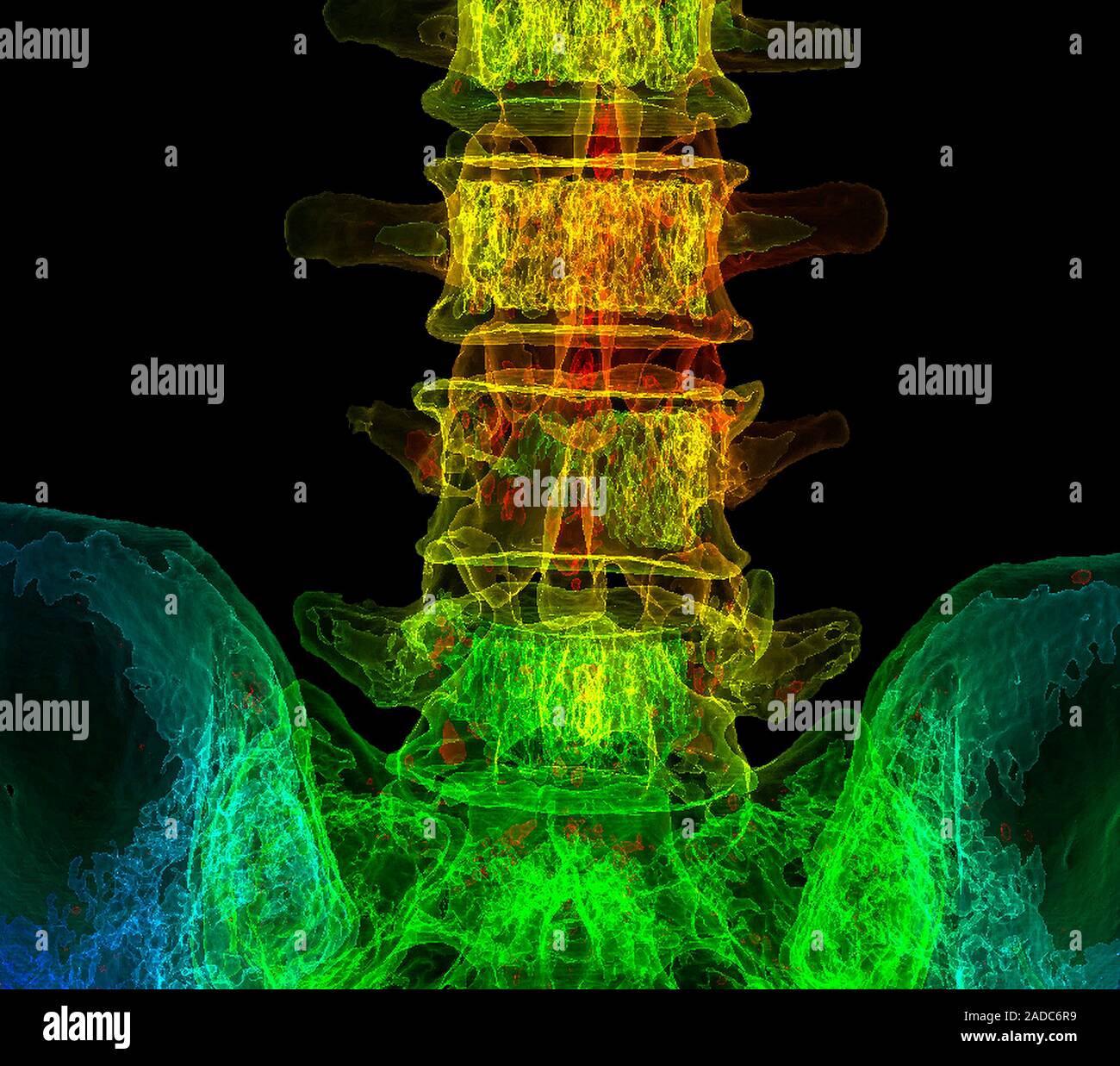 Lumbar spine degeneration. Digitally enhanced 3D computed tomography ...
