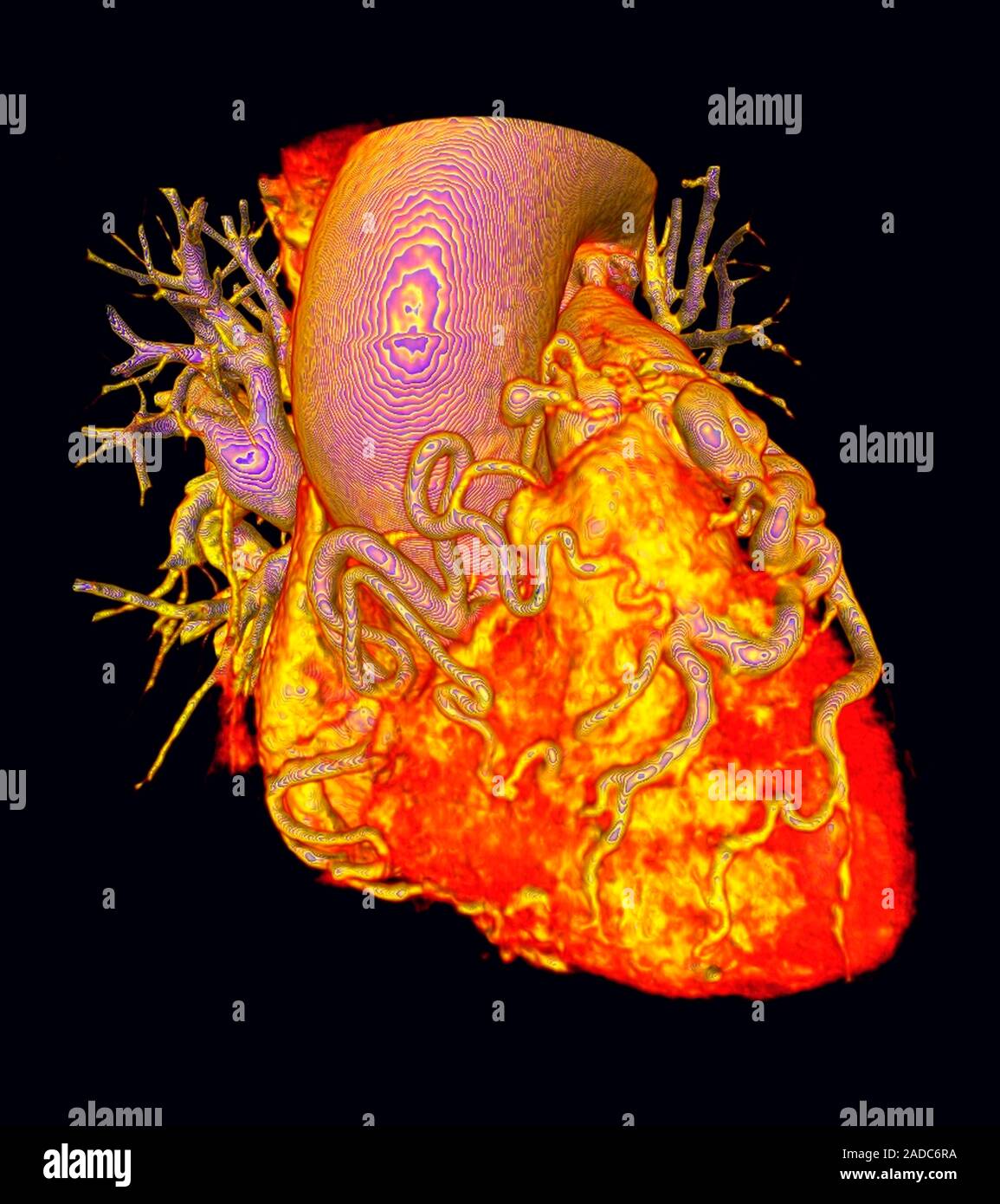 Heart with dilated coronary arteries. Digitally enhanced 3D computed ...