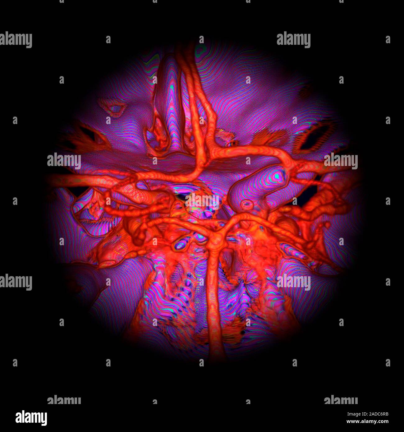 Intracranial arteries. Digitally enhanced 3D computed tomography (CT ...