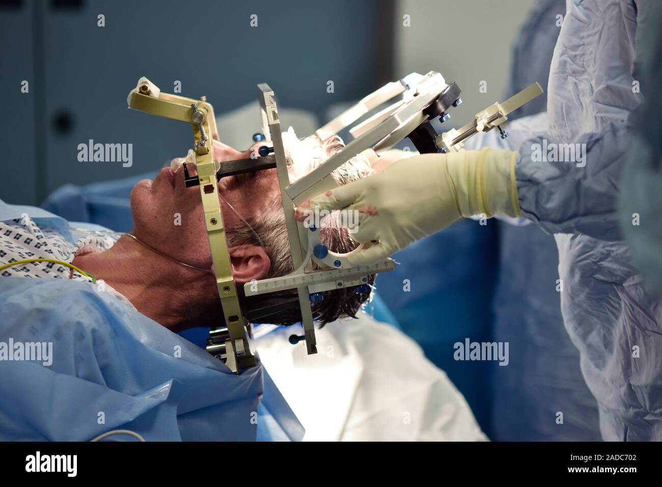 Deep brain stimulation surgery. Stereotactic frame being used on a ...