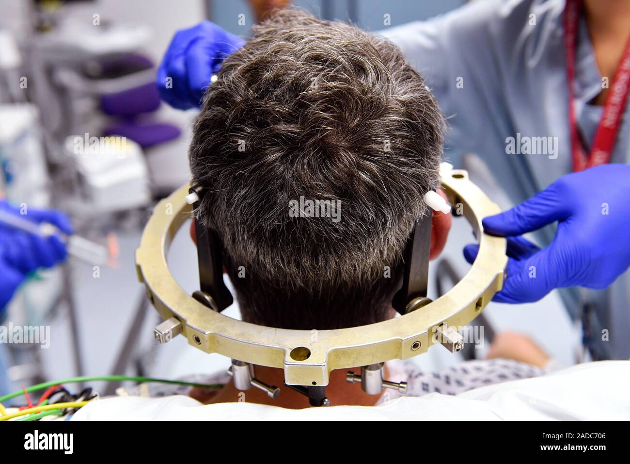 Deep brain stimulation surgery. Stereotactic frame being used on a ...