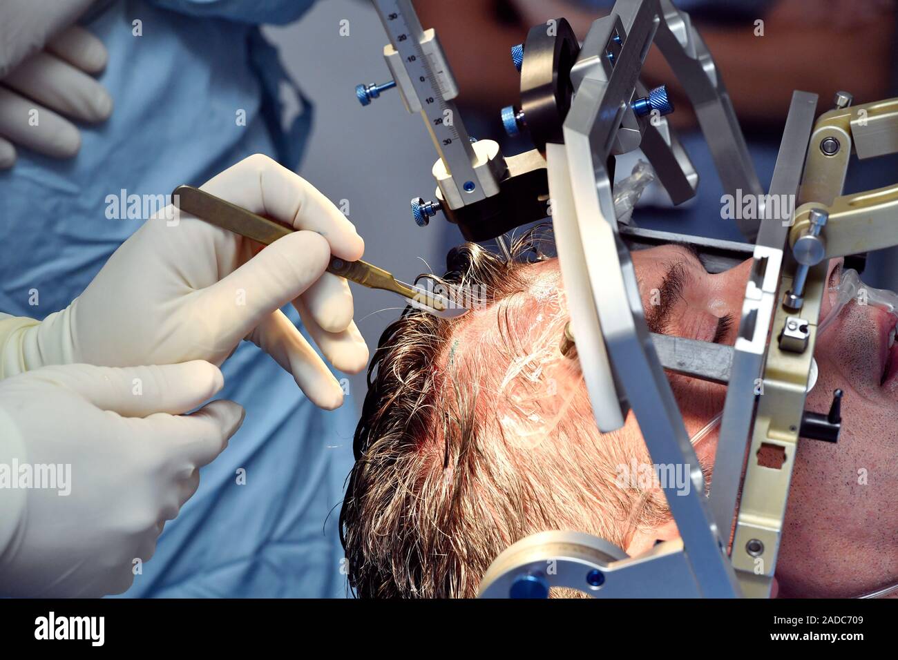 Deep brain stimulation surgery. Scalpel and stereotactic frame being ...