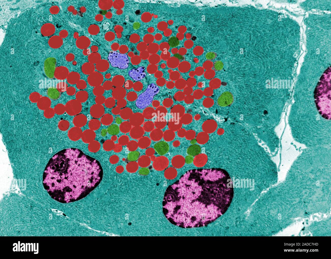 False colour transmission electron micrograph (TEM) showing a serous ...