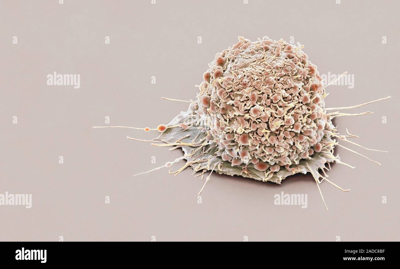 Mouth cancer cell. Coloured scanning electron micrograph (SEM) of a ...